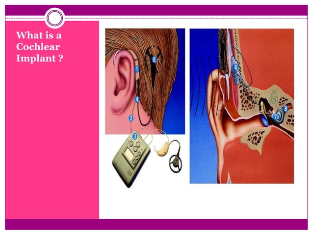 Recent Advances in Cochlear Implant Candidacy | PPSX | Ear, Nose and ...