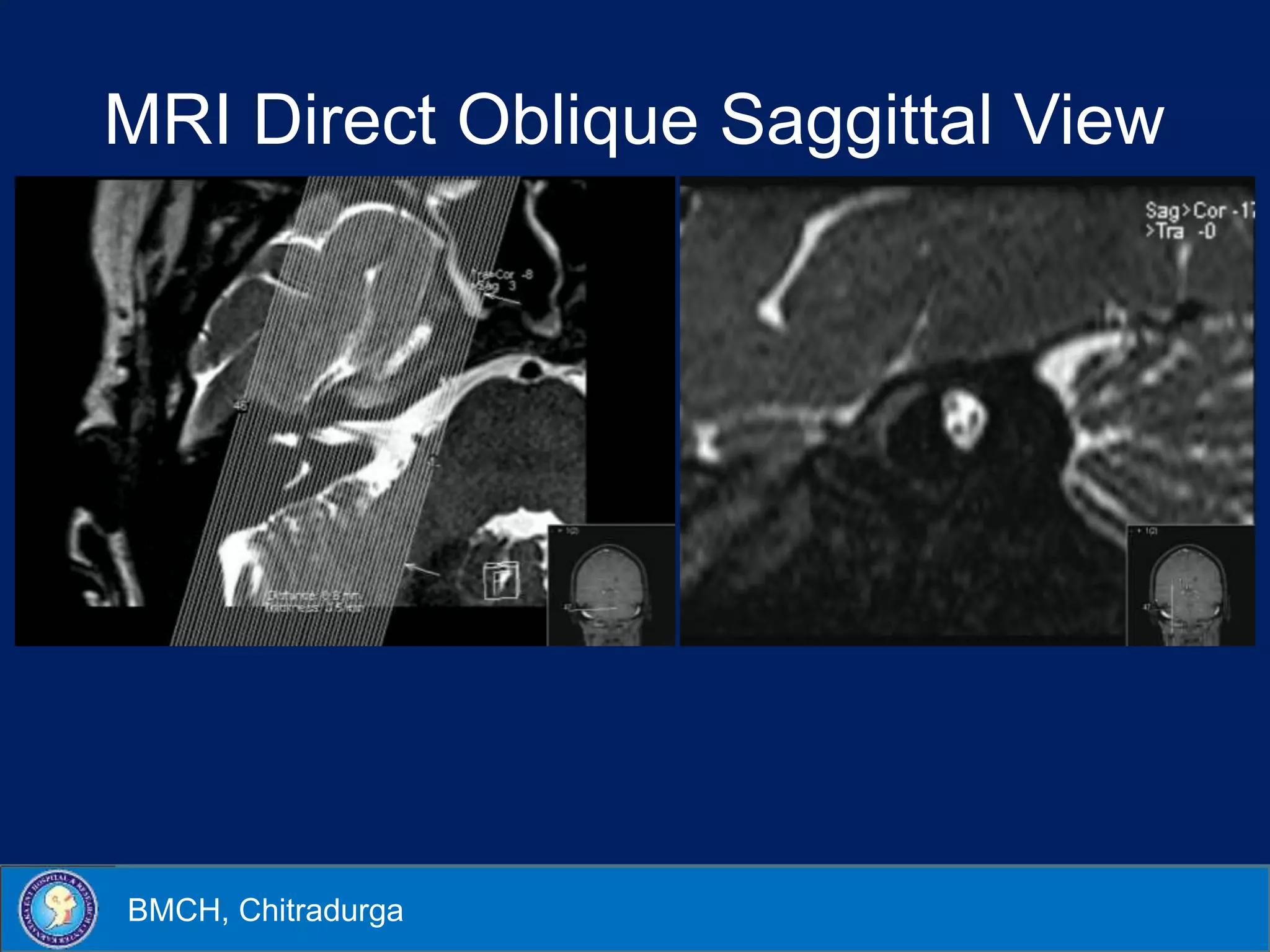 Cochlear implant imaging | PPSX