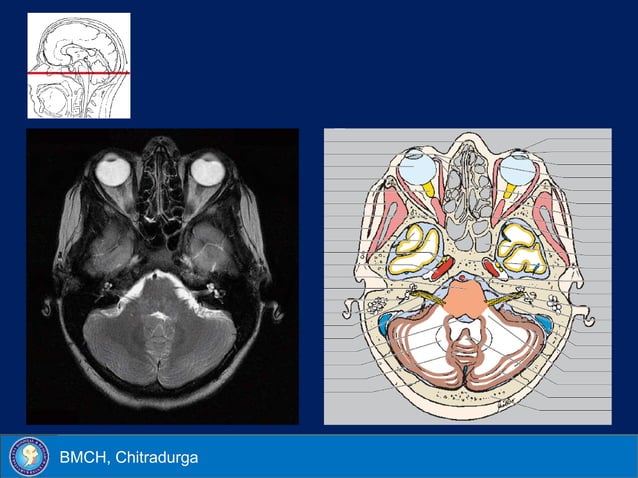 Cochlear implant imaging | PPSX