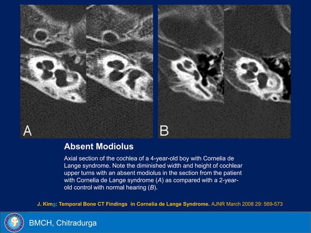 Cochlear implant imaging | PPSX