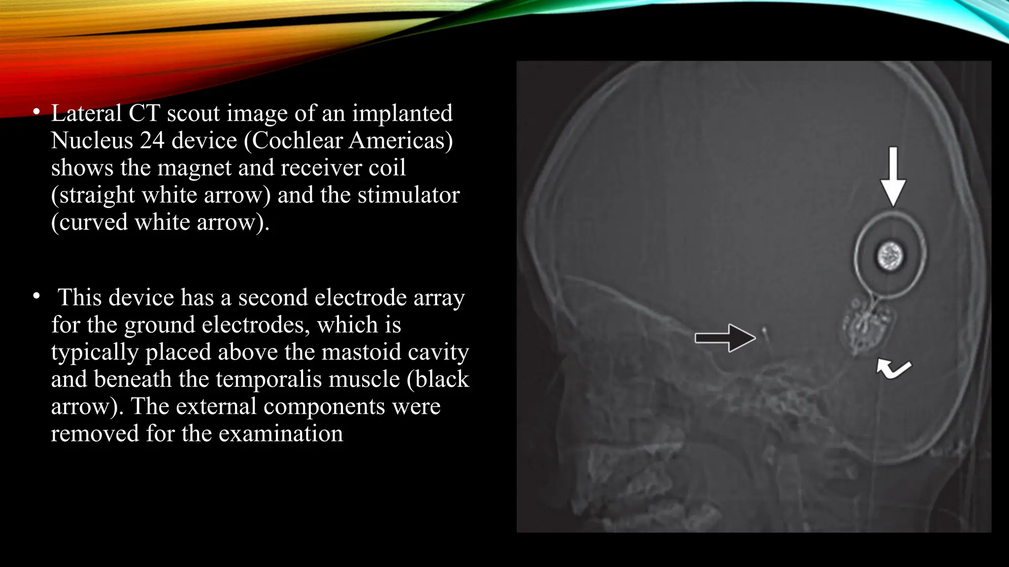 Cochlear implant imaging, radiological features | PPTX