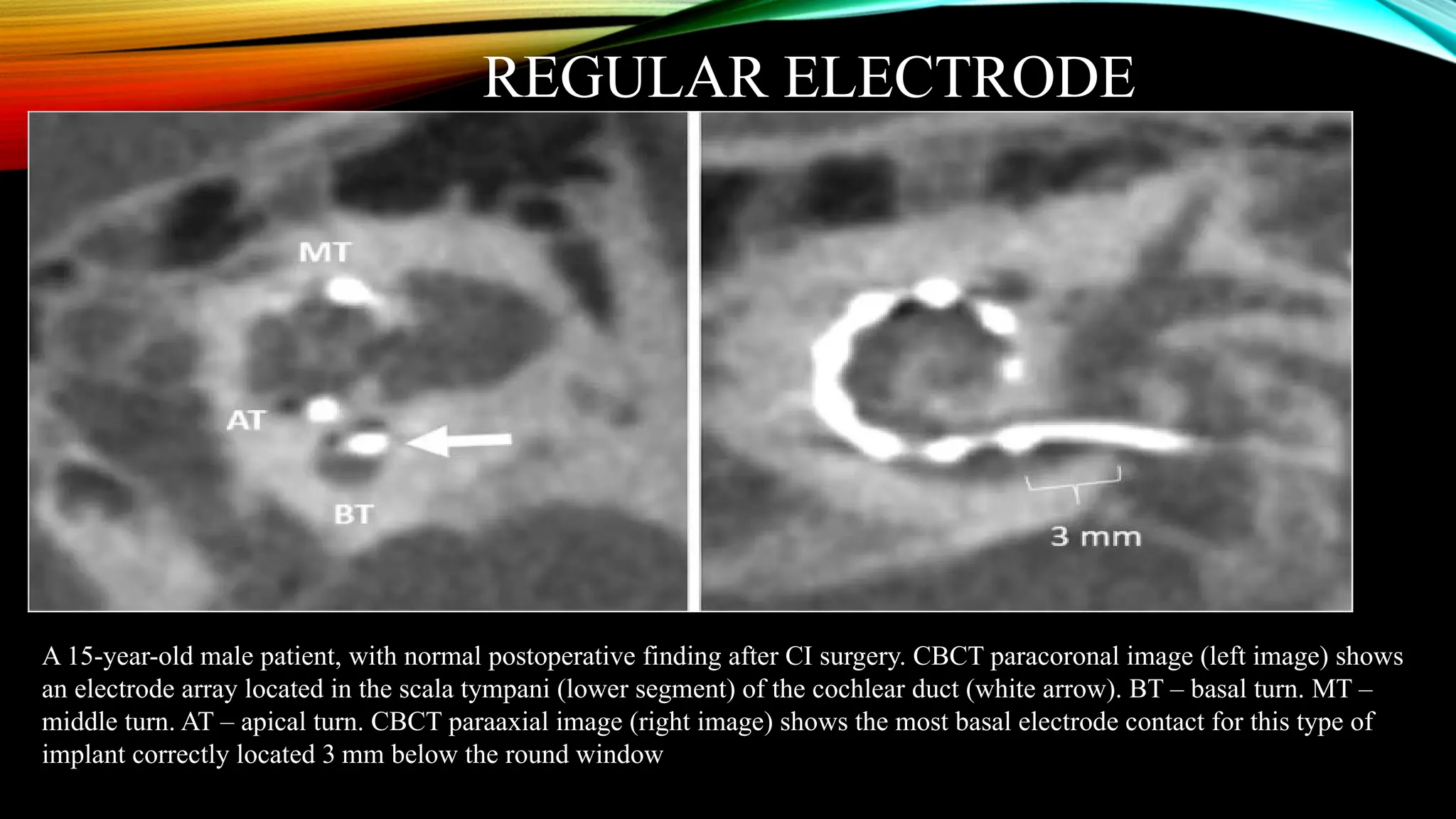 Cochlear implant imaging, radiological features | PPTX