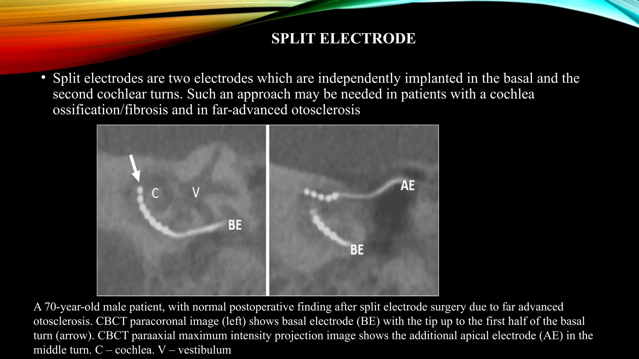 Cochlear implant imaging, radiological features | PPTX