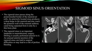 Cochlear implant imaging, radiological features | PPTX