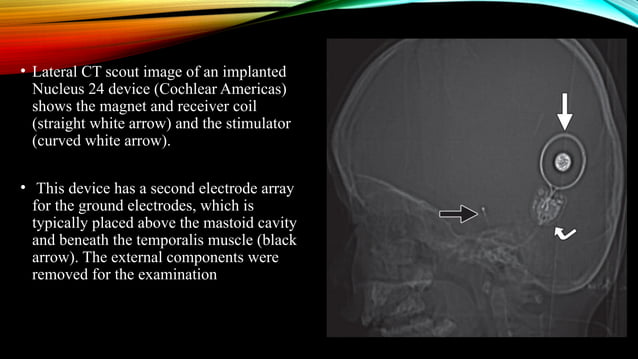 Cochlear implant imaging, radiological features | PPT