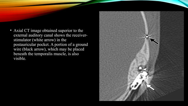 Cochlear implant imaging, radiological features | PPT