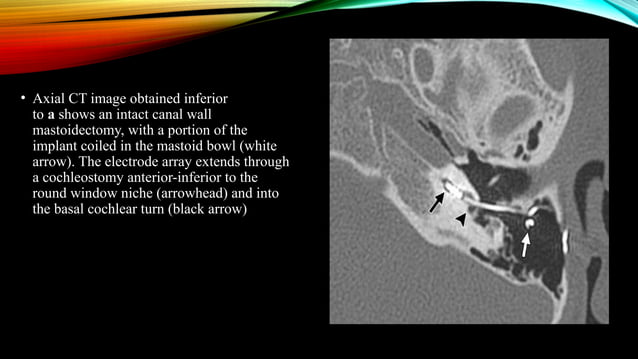 Cochlear implant imaging, radiological features | PPT