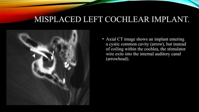 Cochlear implant imaging, radiological features | PPT