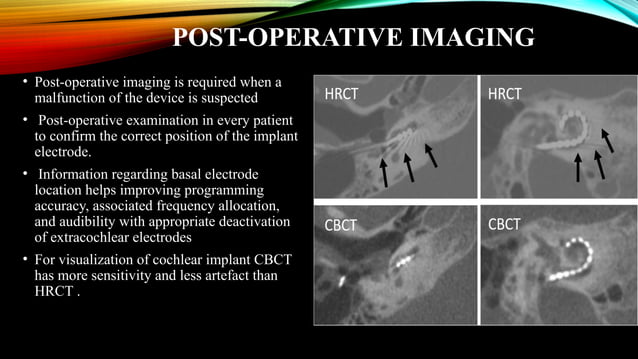 Cochlear implant imaging, radiological features | PPT