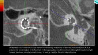 Cochlear implant imaging, radiological features | PPTX