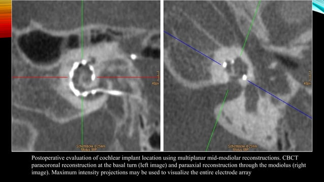 Cochlear implant imaging, radiological features | PPT