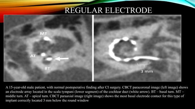 Cochlear implant imaging, radiological features | PPT