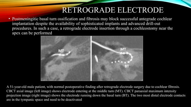Cochlear implant imaging, radiological features | PPT