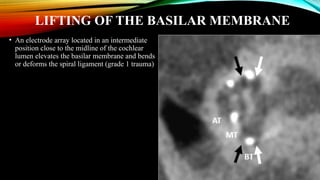 Cochlear implant imaging, radiological features | PPTX