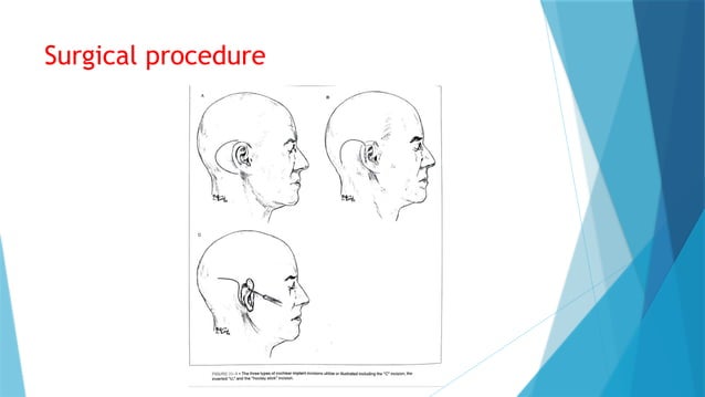 COCHLEAR IMPLANTS use deafness for child | PPT