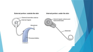 COCHLEAR IMPLANTS use deafness for child | PPT