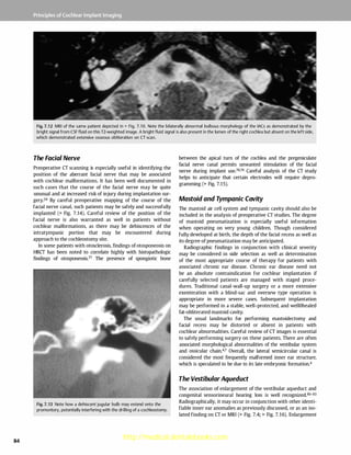 Cochlear implants: Indications, Investigation , Surgery | PDF