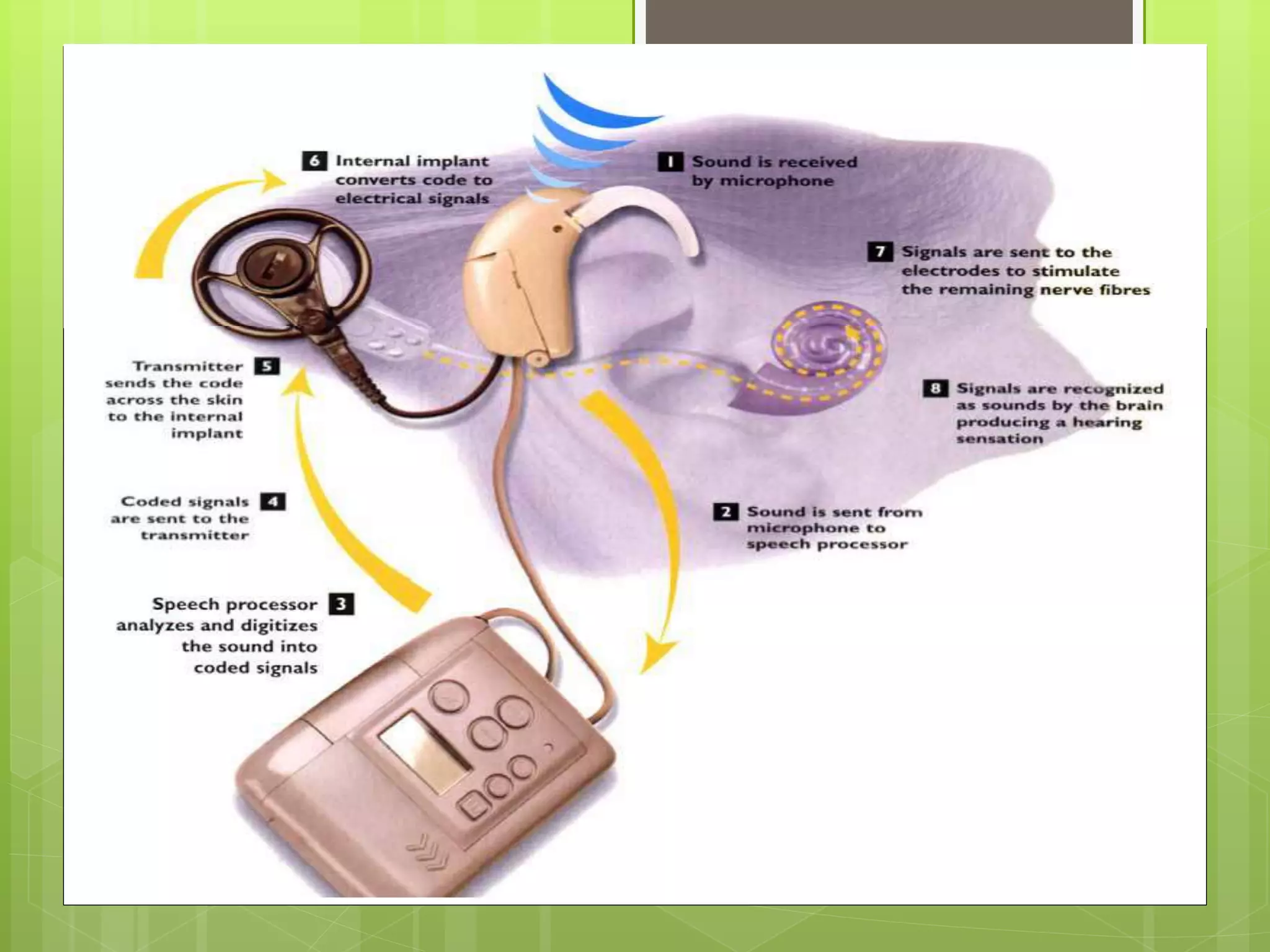 Cochlear implants & cochlear implant technology | PPT