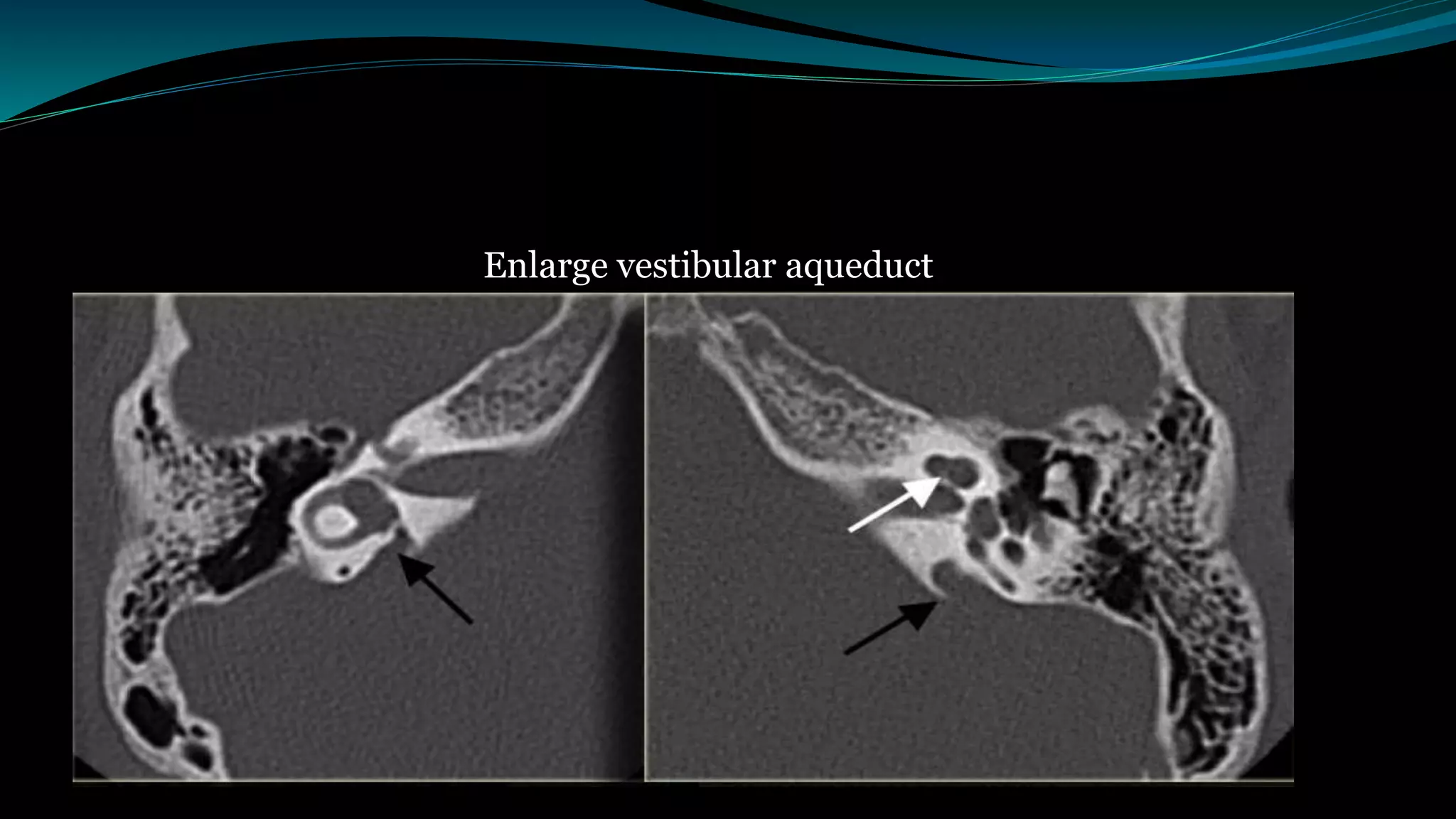 Cochlear implant surgery | PPTX