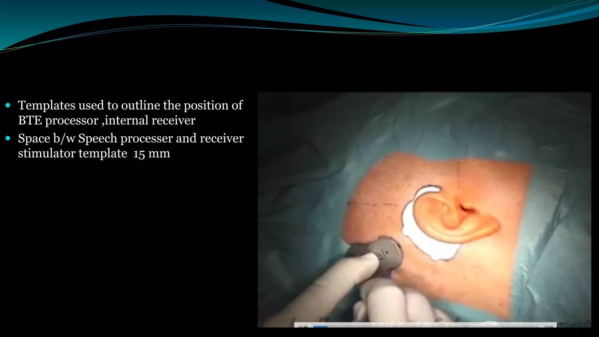 Cochlear implant surgery | PPTX