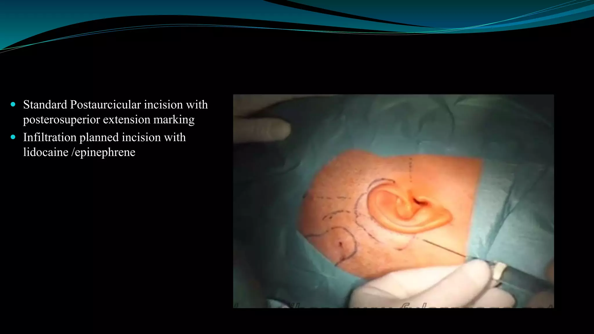 Cochlear implant surgery | PPTX