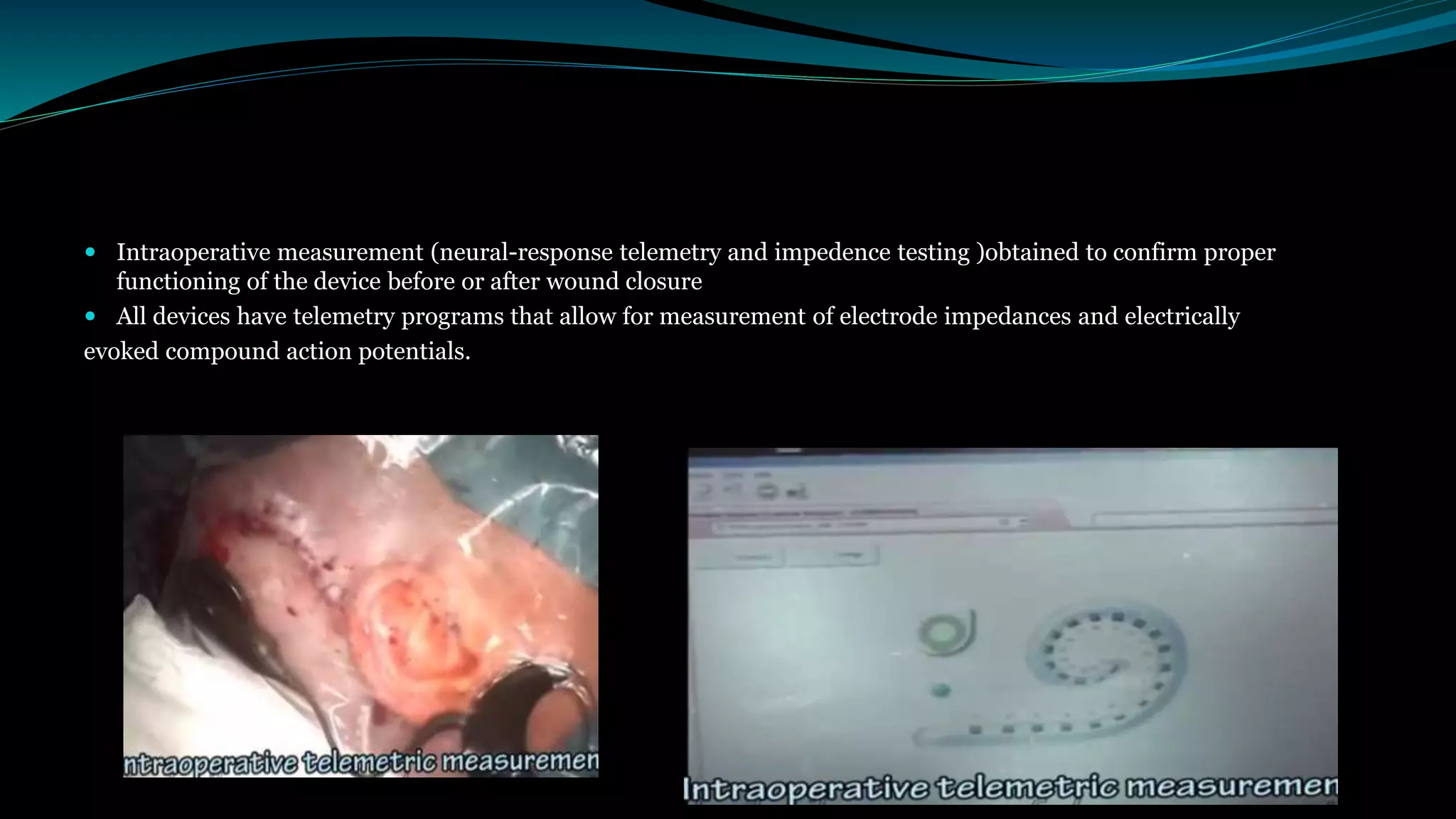 Cochlear implant surgery | PPTX
