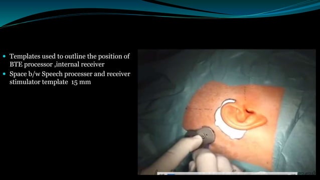 Cochlear implant surgery | PPTX | Digital Audio | Computer Software and ...