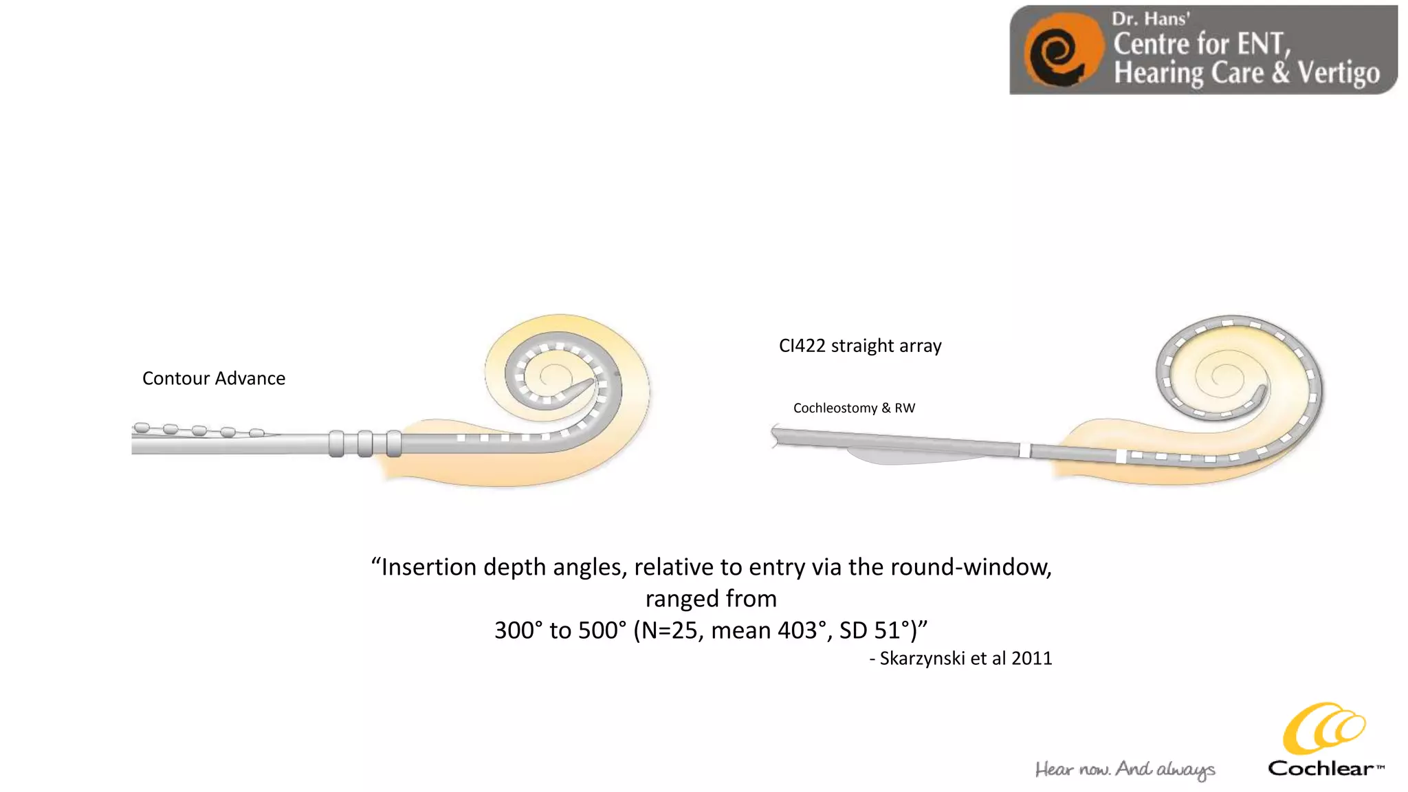 Cochlear implant systems | PPTX