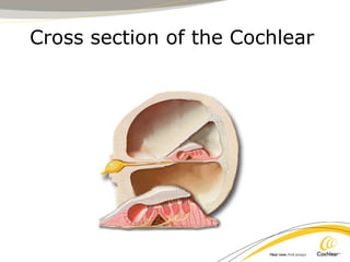 Cochlear ltd tour presentation from an | PPT