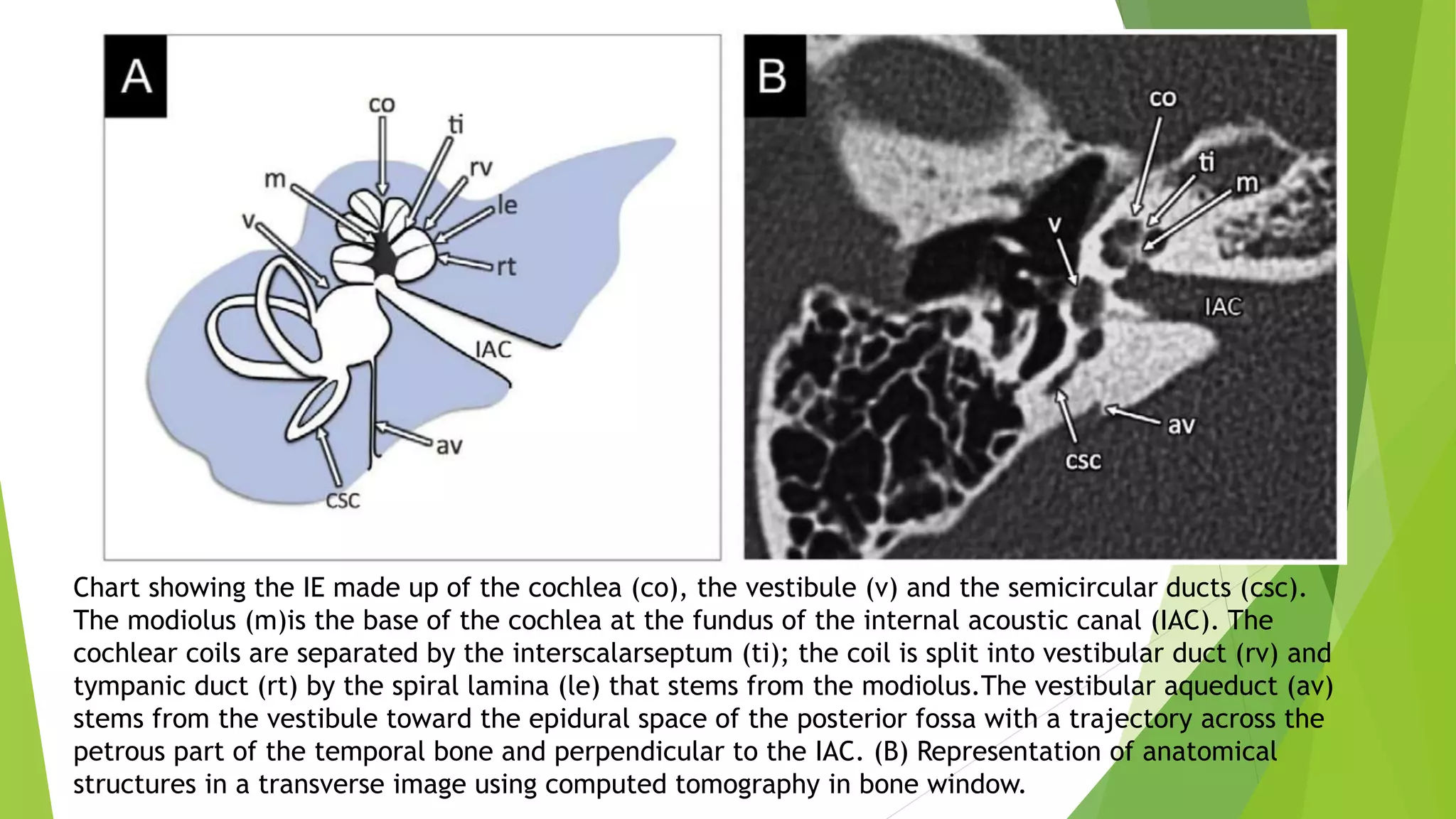 Cochlear malformations | PPTX