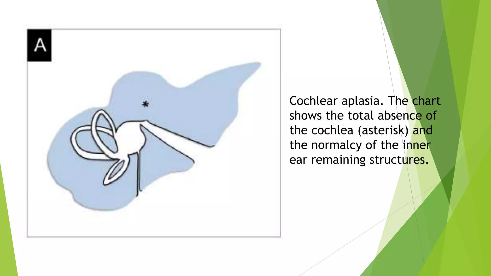 Cochlear malformations | PPTX | Ear, Nose and Throat Conditions ...