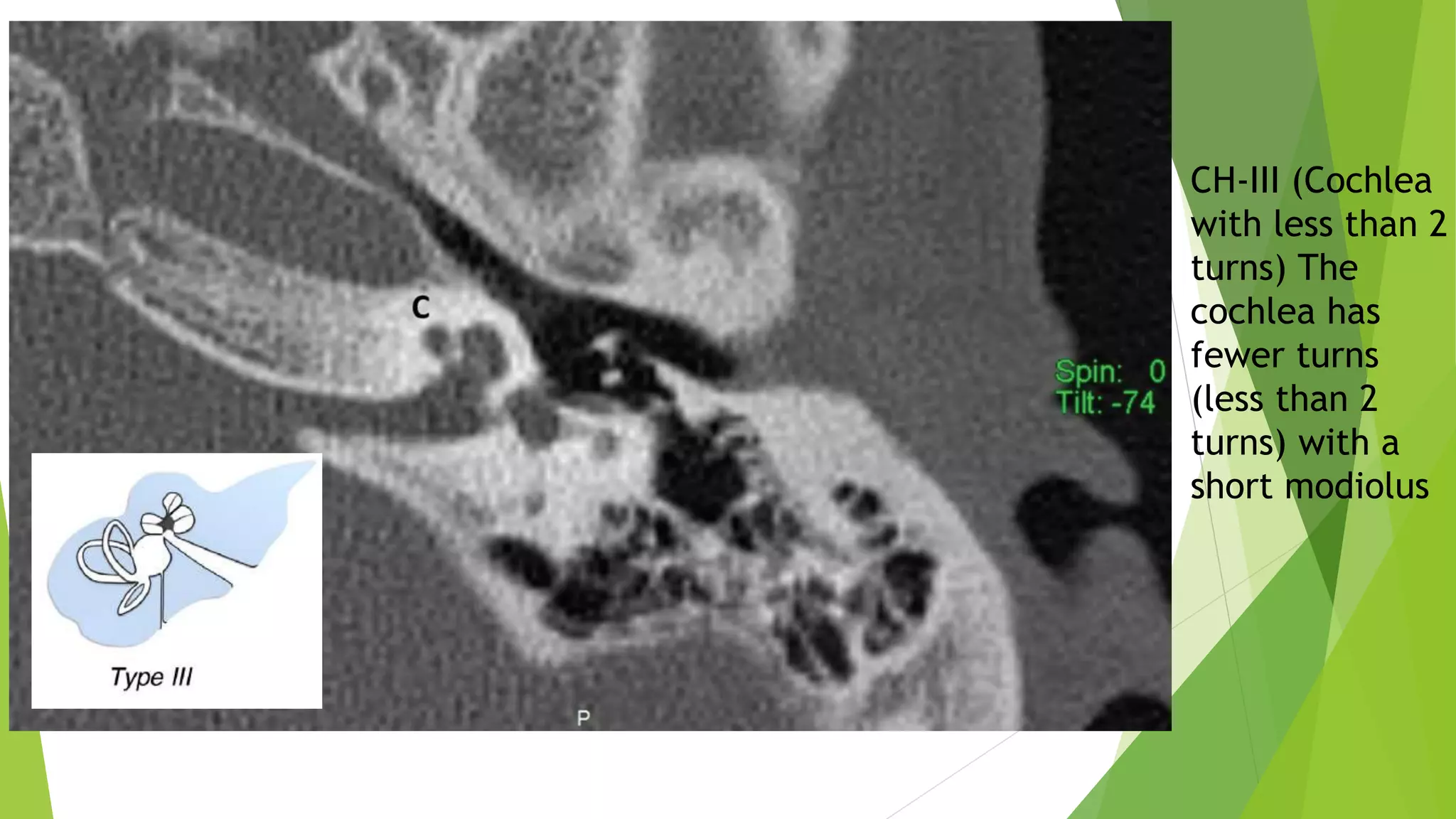 Cochlear malformations | PPTX