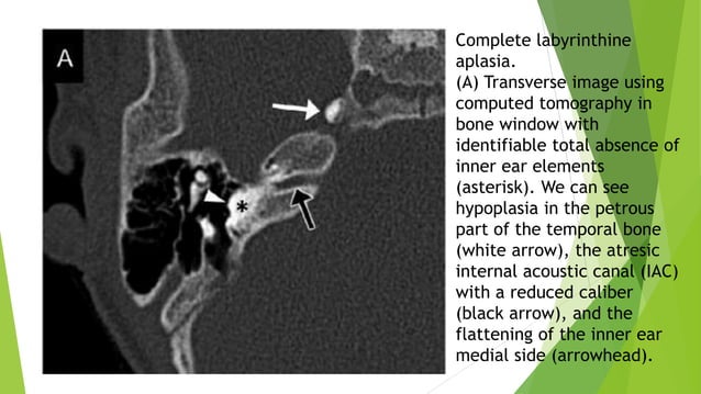 Cochlear malformations | PPTX | Ear, Nose and Throat Conditions ...