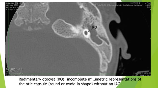Cochlear malformations | PPTX | Ear, Nose and Throat Conditions ...
