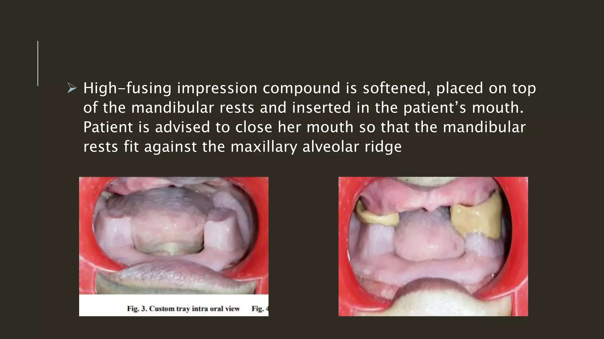 Cocktail impression technique | PPTX