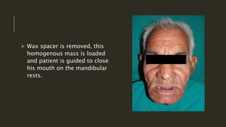 Cocktail impression technique | PPTX