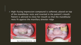 Cocktail impression technique | PPTX