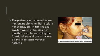 Cocktail impression technique | PPTX