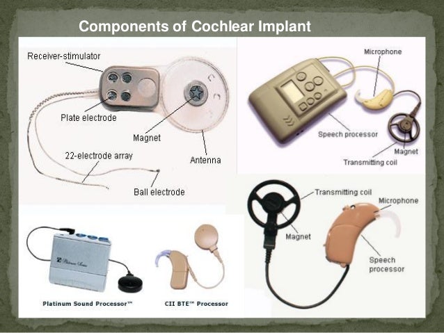 cochlear implant