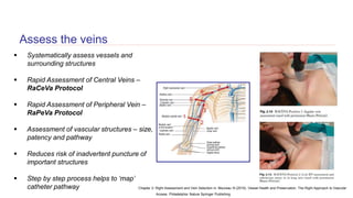 Vascular Access Part 1: Reducing risk and increasing catheter longevity ...
