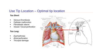 Vascular Access Part 1: Reducing risk and increasing catheter longevity ...