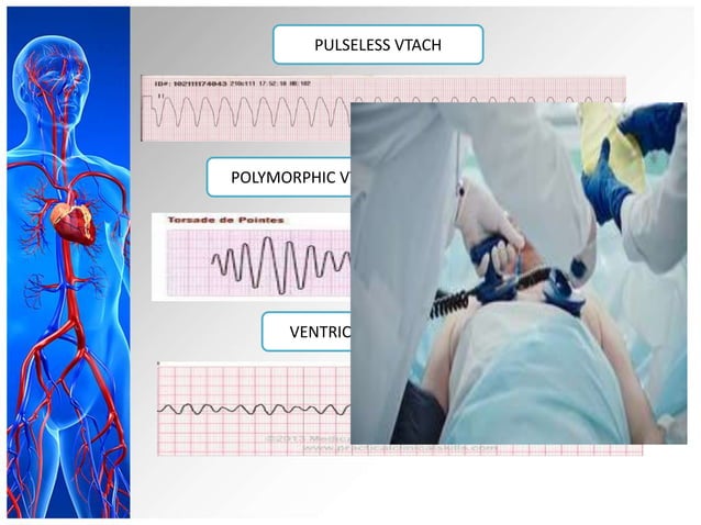 Code blue management | PPTX | First Aid | Injuries