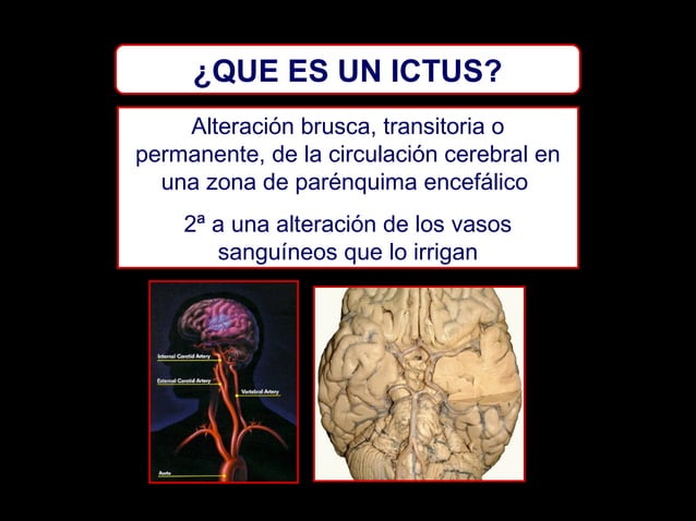 CODIGO ICTUS - CONCEPTOS Y MANEJO | PDF