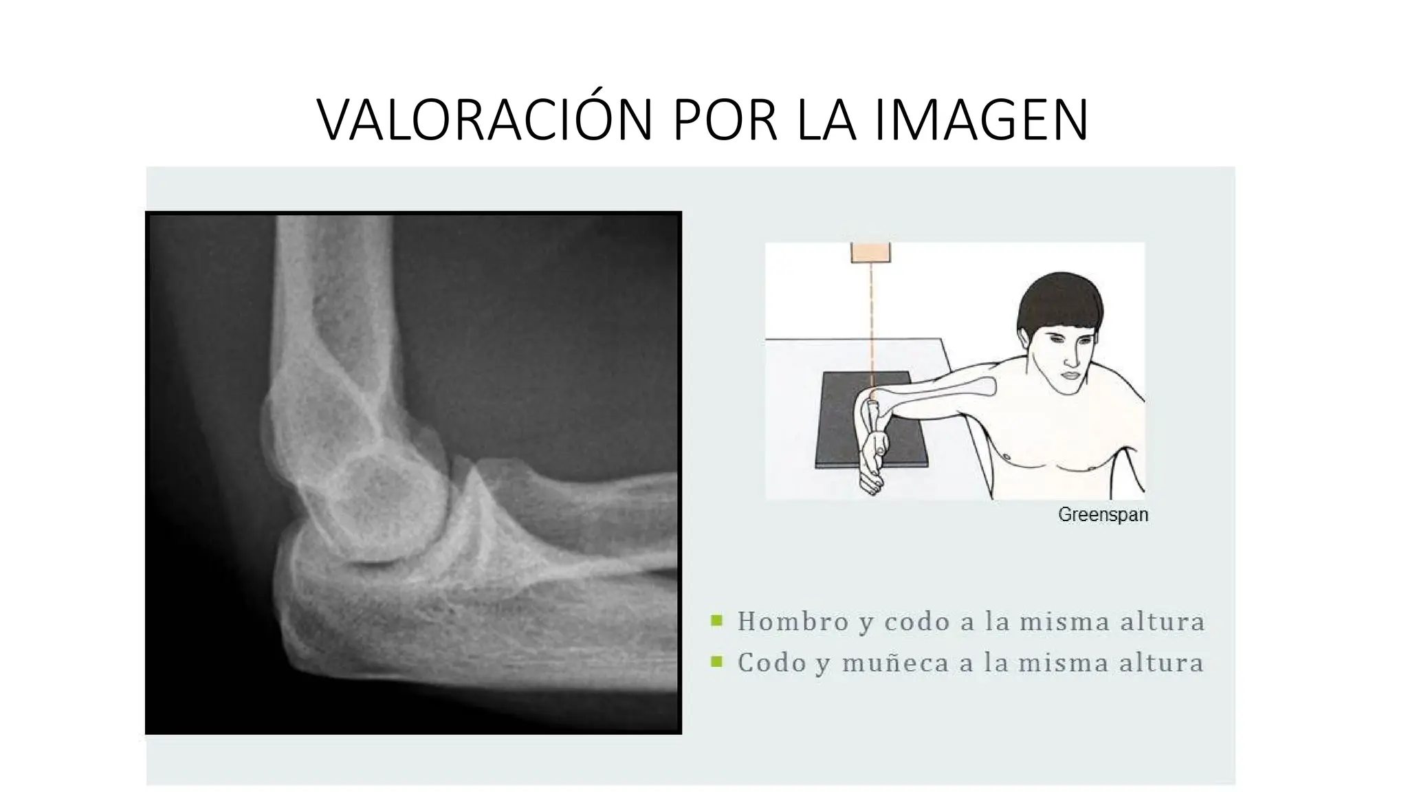 codo 250325.pptx fractura y Luxacion de codo | PPTX