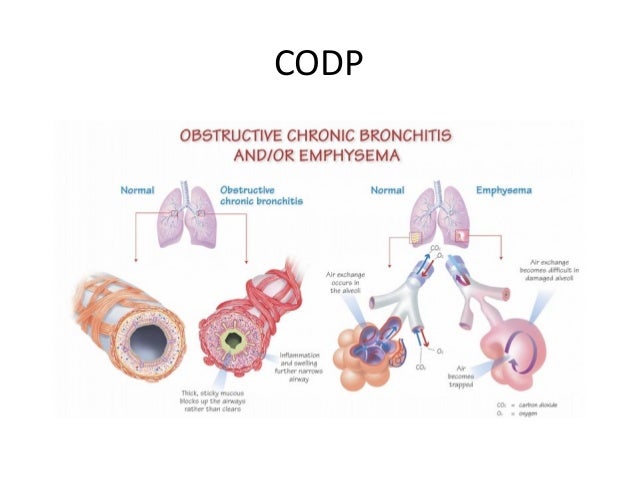 CODP & smoking