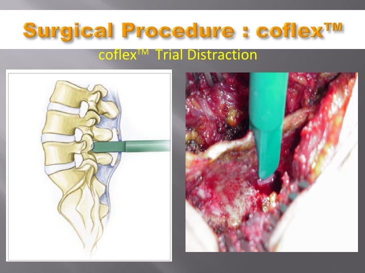 Current Treatment for Lumbar Stenosis : Coflex by Pablo Pazmino MD