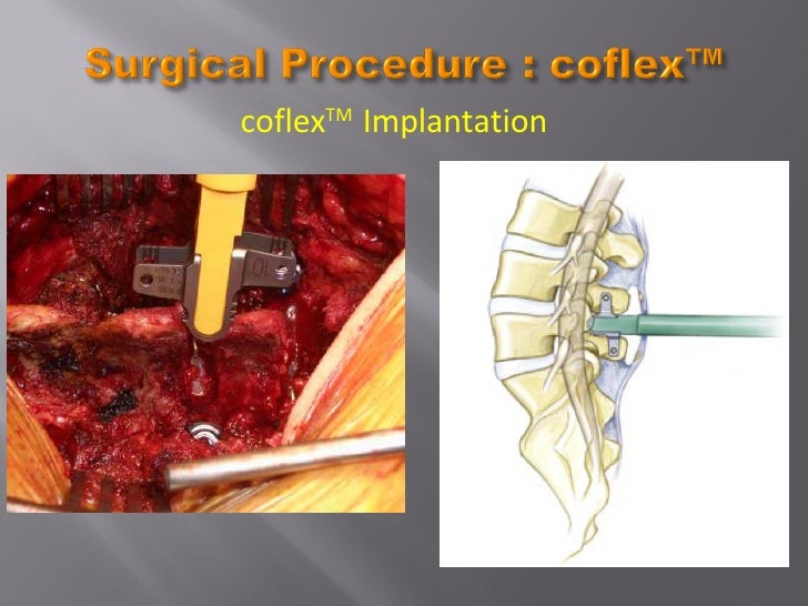 Current Treatment for Lumbar Stenosis : Coflex by Pablo Pazmino MD