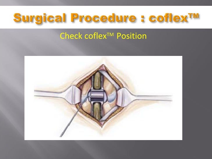 Current Treatment for Lumbar Stenosis : Coflex by Pablo Pazmino MD