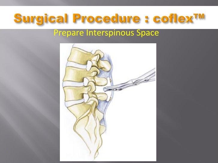 Current Treatment for Lumbar Stenosis : Coflex by Pablo Pazmino MD