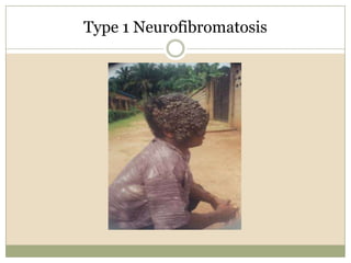 Cognitive Impairment In Children With Type 1 Neurofibromatosis | PPT